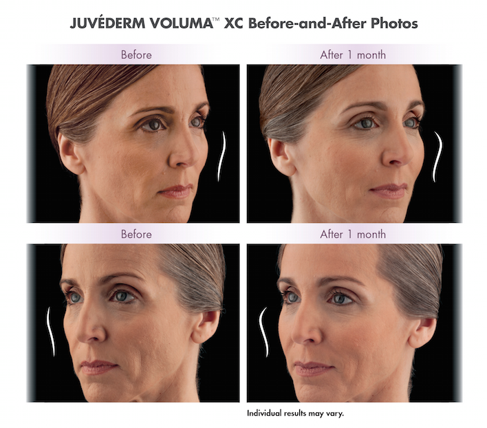 Juvederm Voluma in New Jersey | The Godek Center